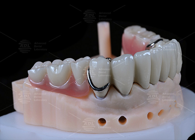 China Dental Lab Top 5 in China PFM Bridge with Post and Core + Metal ...