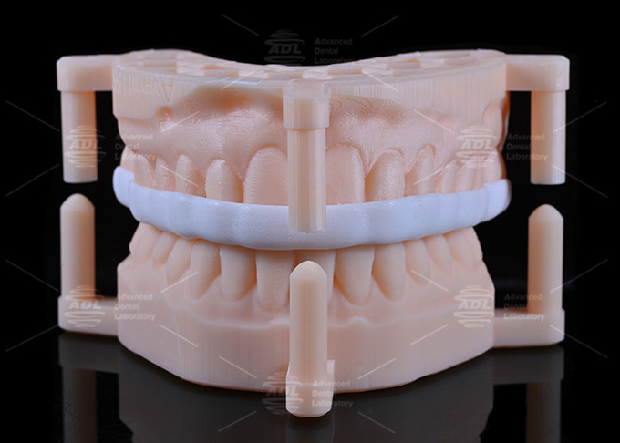 Nylon Occlusal Splint