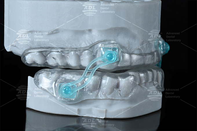 China Dental Lab Top 5 in China Erkodent Silensor
