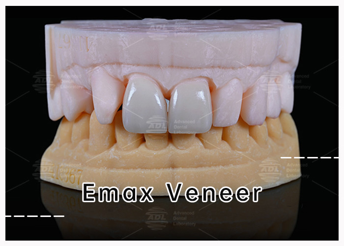 Emax Veneer
