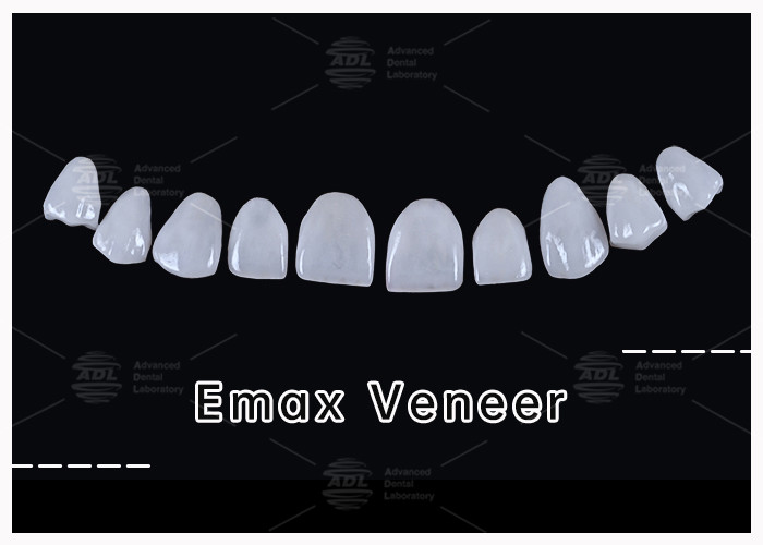 Emax Veneer