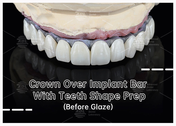 Crown Over Implant Bar With Teeth Shape Prep