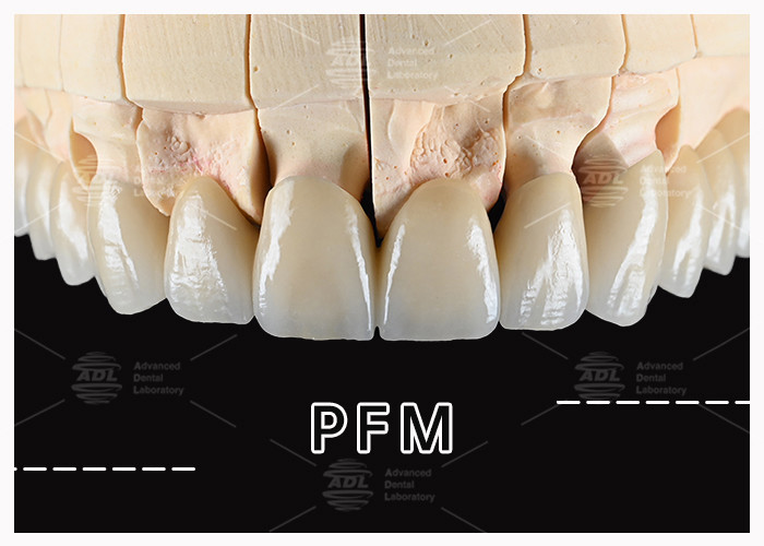 China Advanced Dental Laboratory latest company cases about PFM