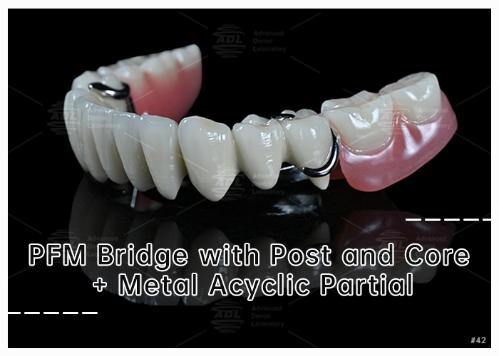 China Dental Lab Top 5 in China PFM Bridge with Post and Core + Metal ...