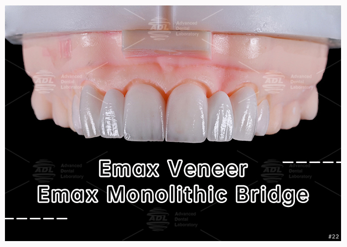 China Dental Lab Top 5 in China Emax Veneer+Emax Monolithic Bridge