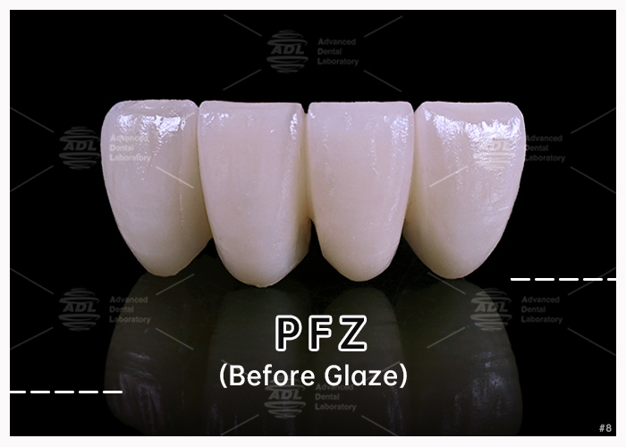 China Dental Lab Top 5 in China PFZ(Before Glaze)