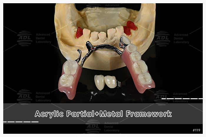 China Dental Lab Top 5 in China Acrylic Partial+Metal Framework