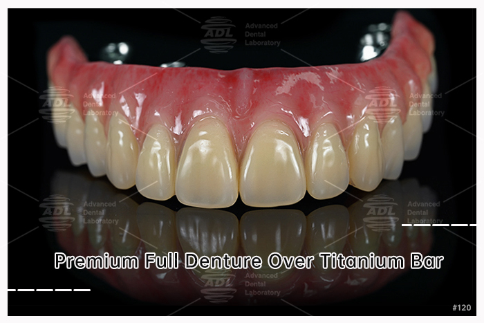 China Dental Lab Top 5 in China Premium Full Denture Over Titanium Bar