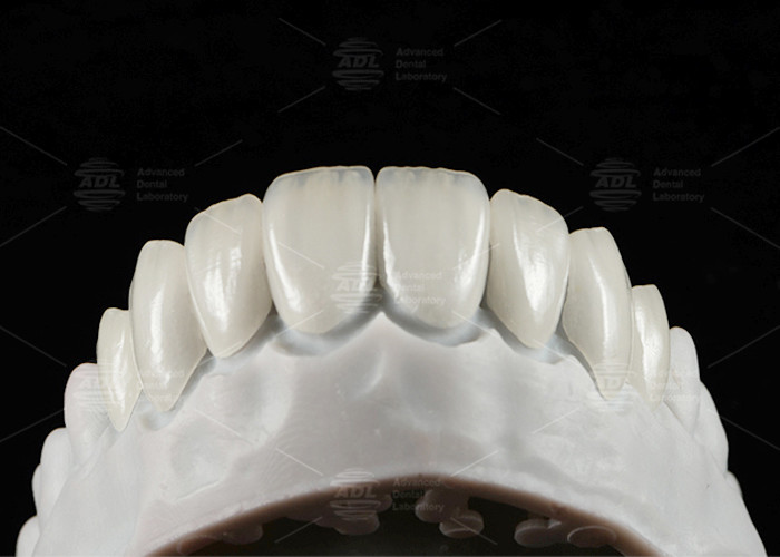 Natural Pressed EMAX Veneer Strength 16 Shades Emax Teeth Veneers