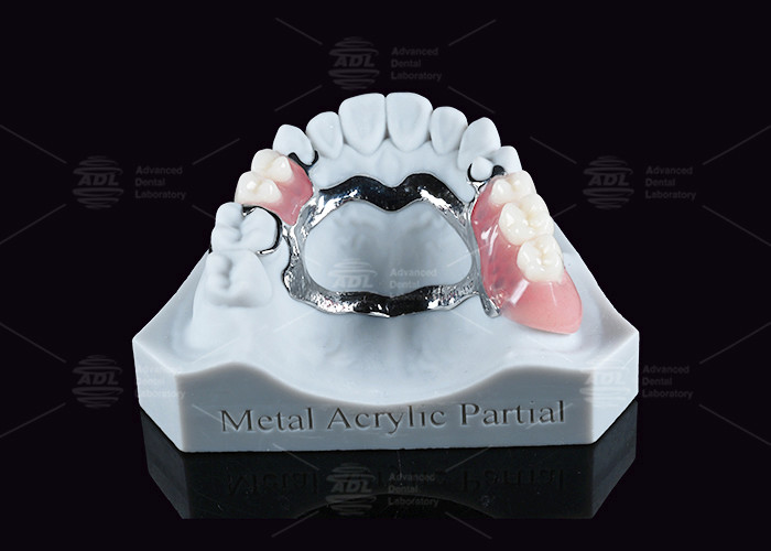 Removable Metal Acrylic Partial Denture With Clasps For Partial Chewing