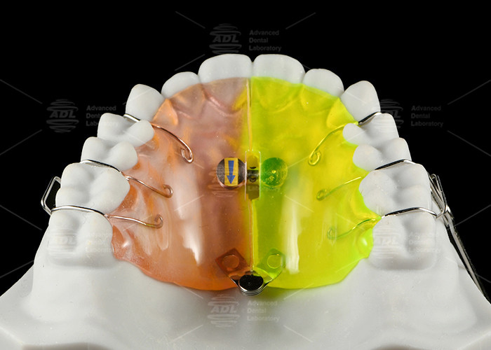 Orthodontic Fan Shaped Expander Provides Posterior Crossbite Free ...
