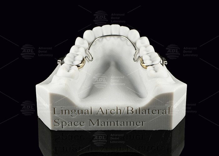 Lingual Arch Biliteral Space Maintainer Stainless Steel Teeth Space ...